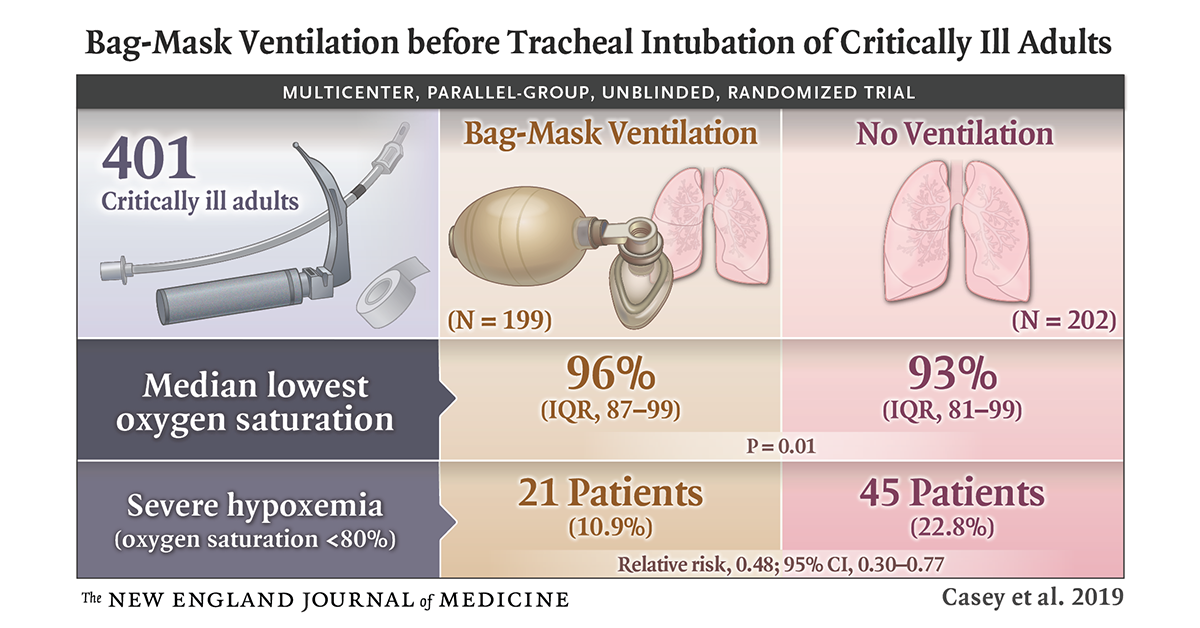 Ventilation par masque lors de l'intubation trachéale chez les adultes ...